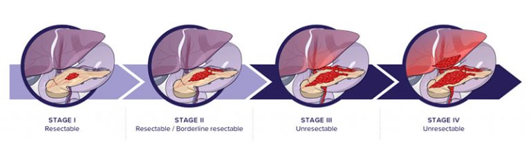 Cáncer de páncreas - Amadix